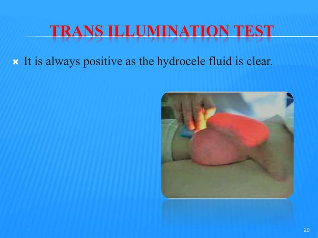 hydrocele ppt final.pptx