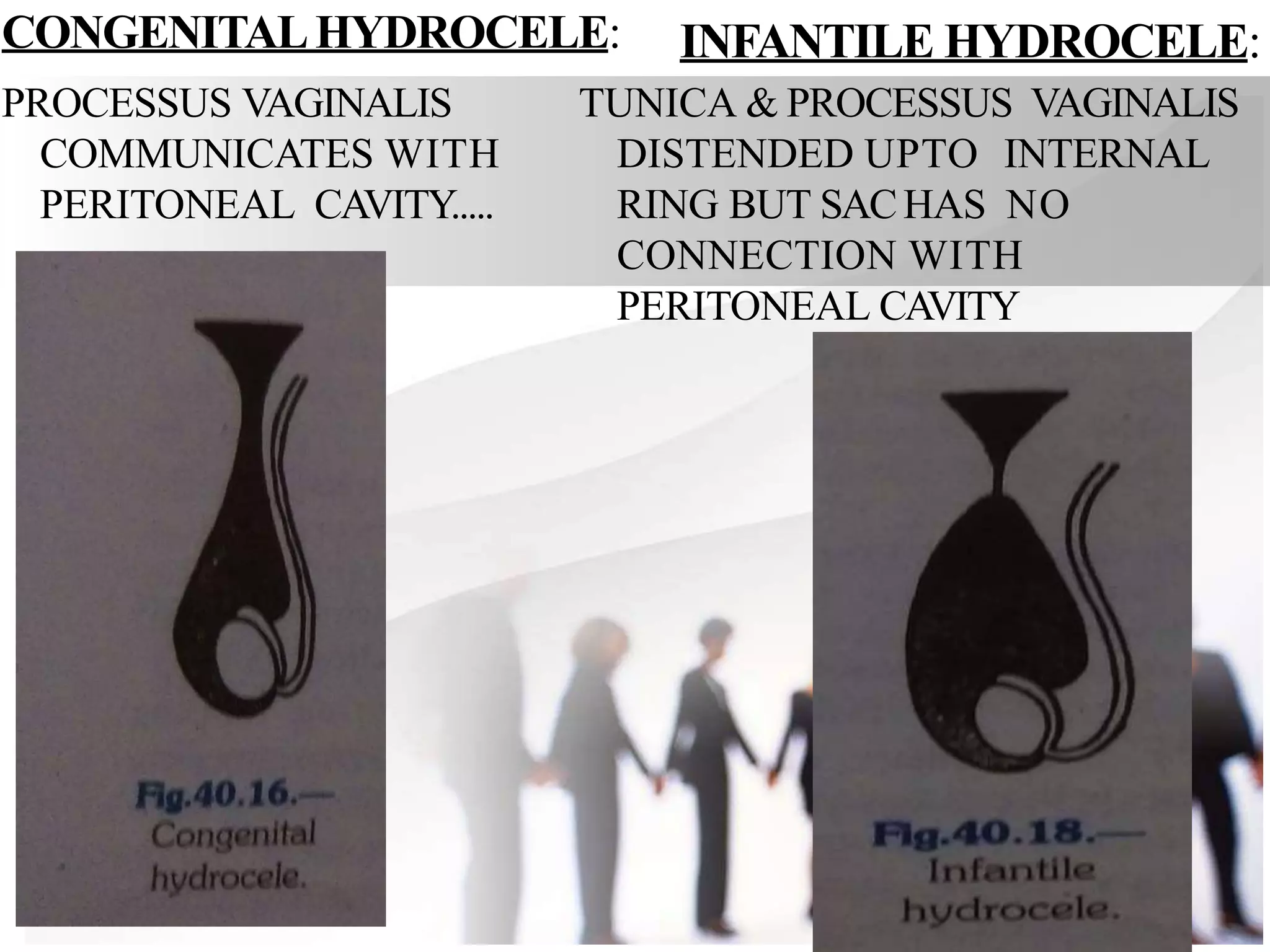 Hydrocele- All types & treatment options | PPTX