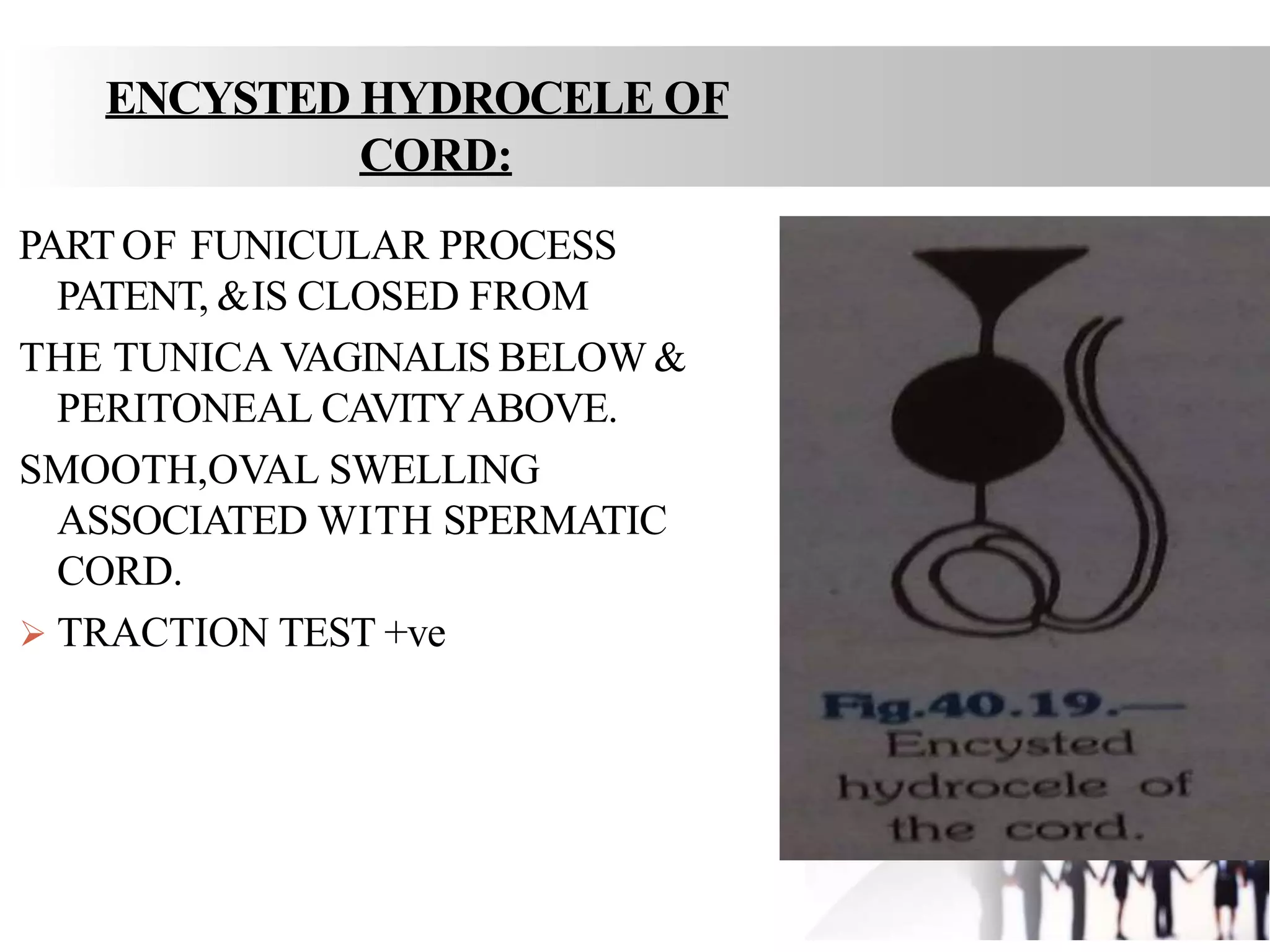 Hydrocele- All types & treatment options | PPTX
