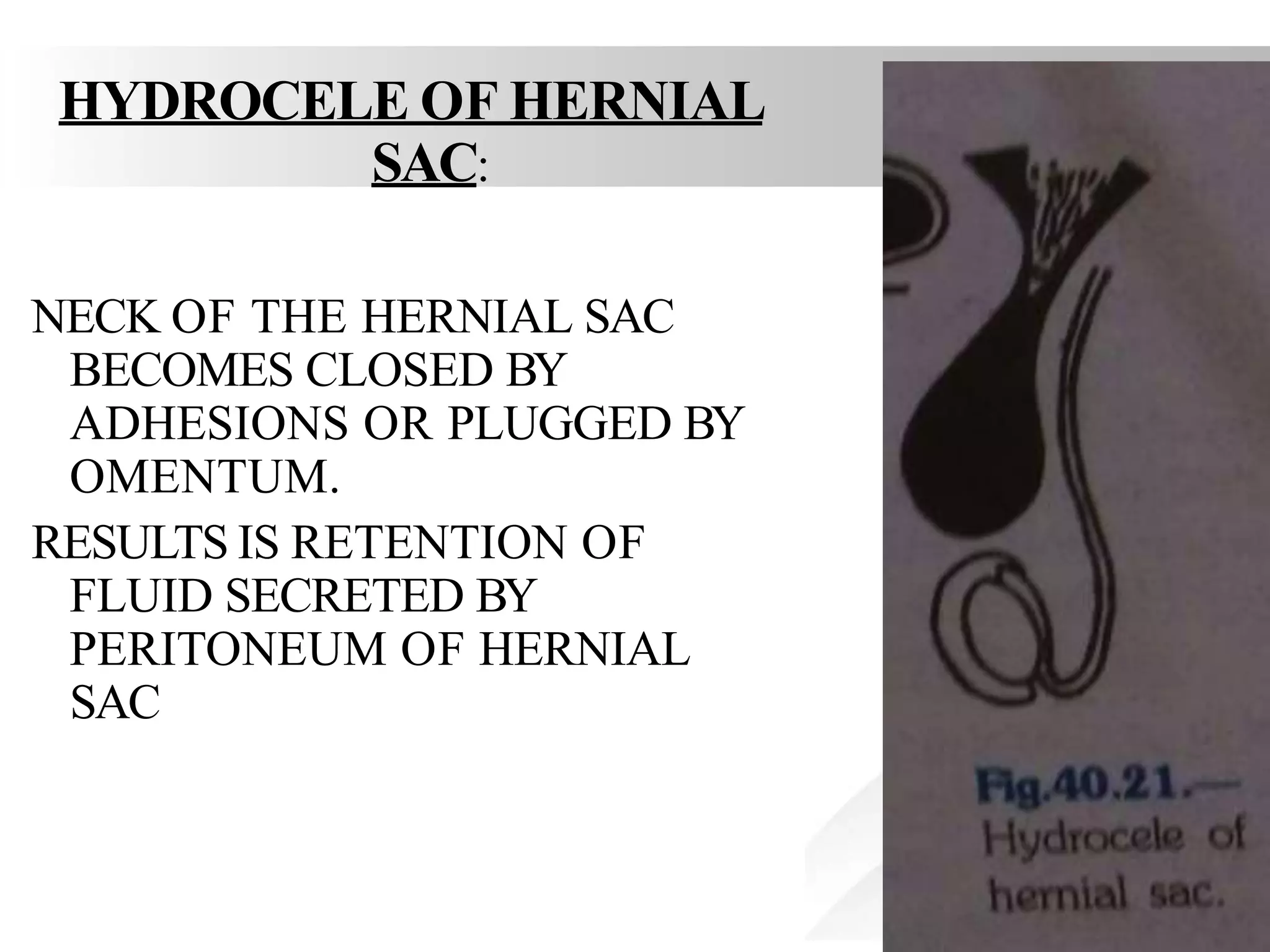 Hydrocele- All types & treatment options | PPTX
