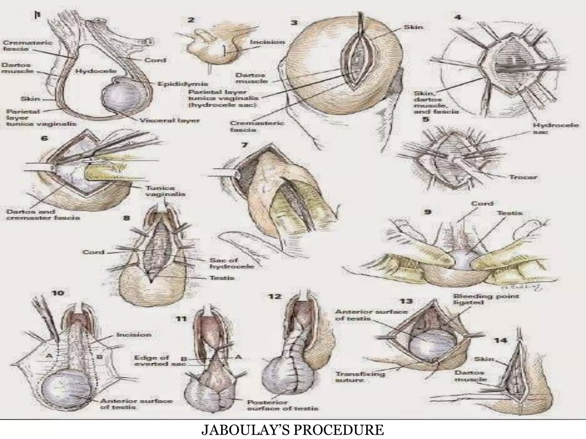 Hydrocele- All types & treatment options | PPTX