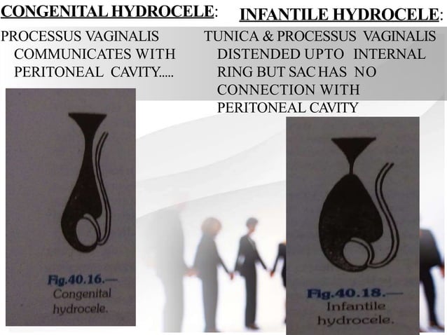 Hydrocele- All types & treatment options | PPTX