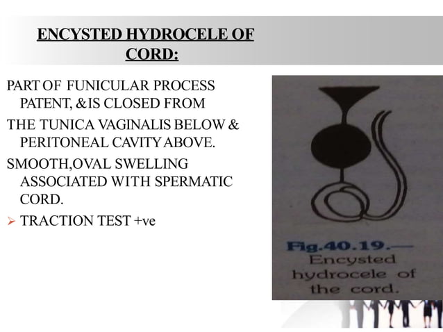 Hydrocele- All types & treatment options | PPTX