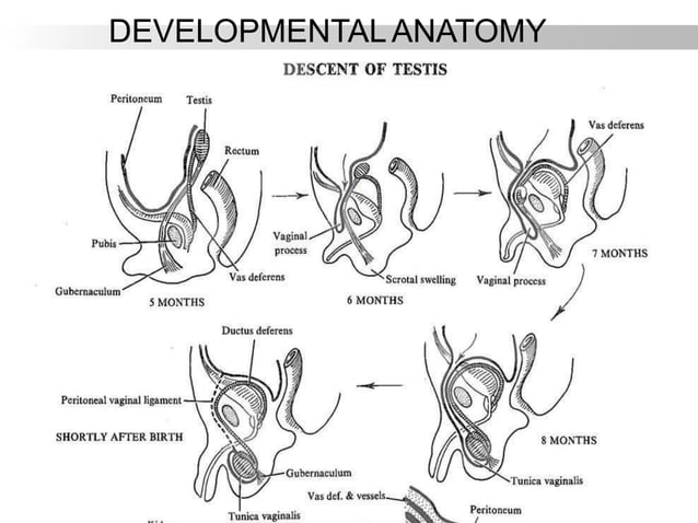 Hydrocele- All types & treatment options | PPTX
