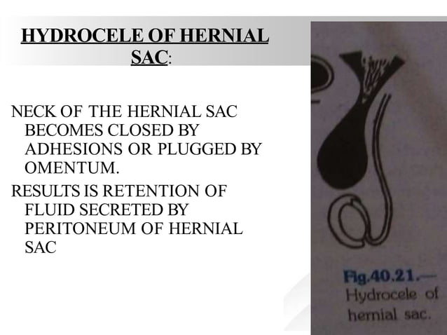 Hydrocele All Types And Treatment Options