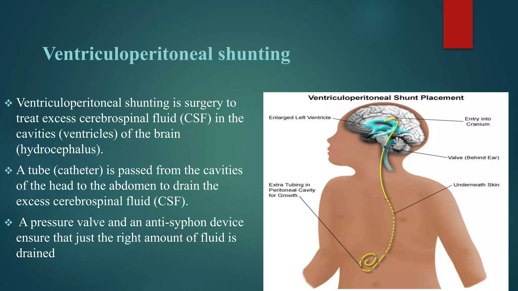 HYDROCEPHALUS | PPTX