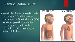 HYDROCEPHALUS | PPT