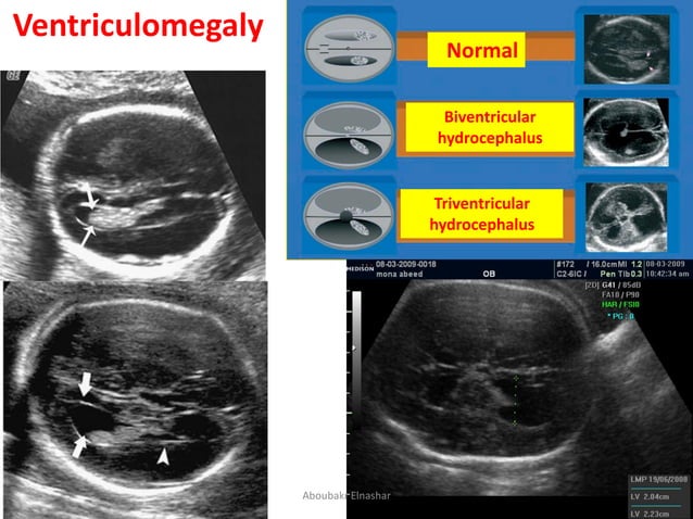 Management of Fetal hydrocephalus | PPT