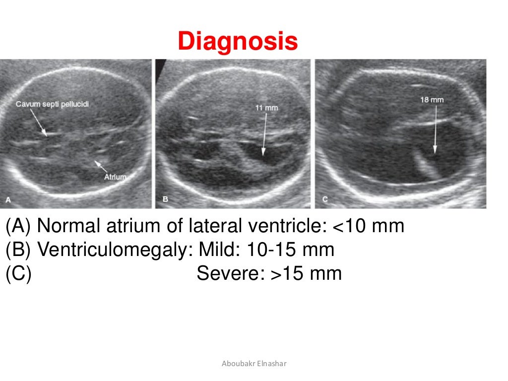 Management Of Fetal Hydrocephalus Hydrocephalus Diagnosis And