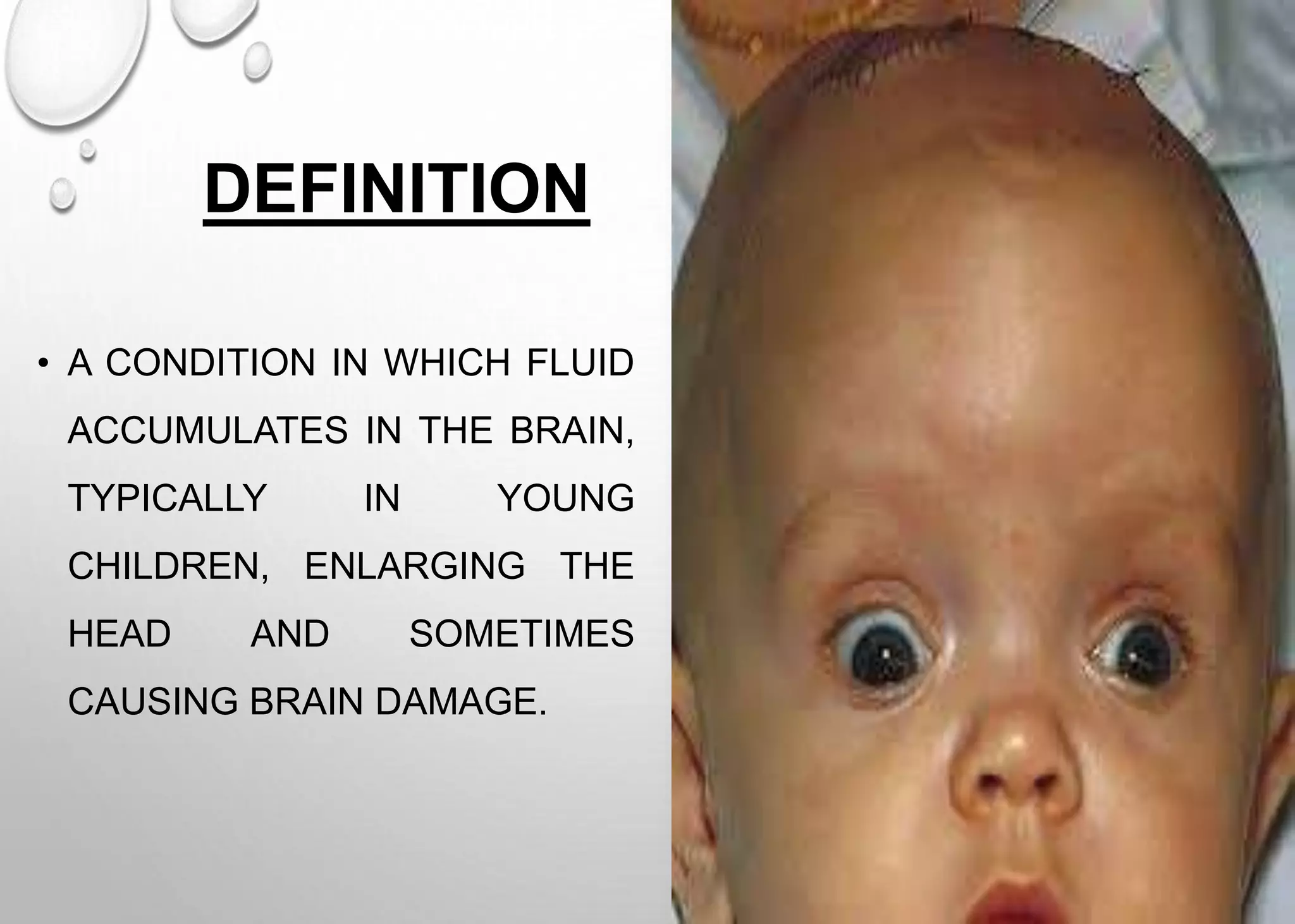 Hydrocephalous with nursing management | PPTX