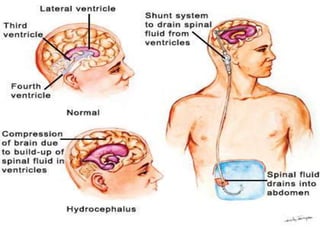 Hydrocephalous with nursing management | PPTX