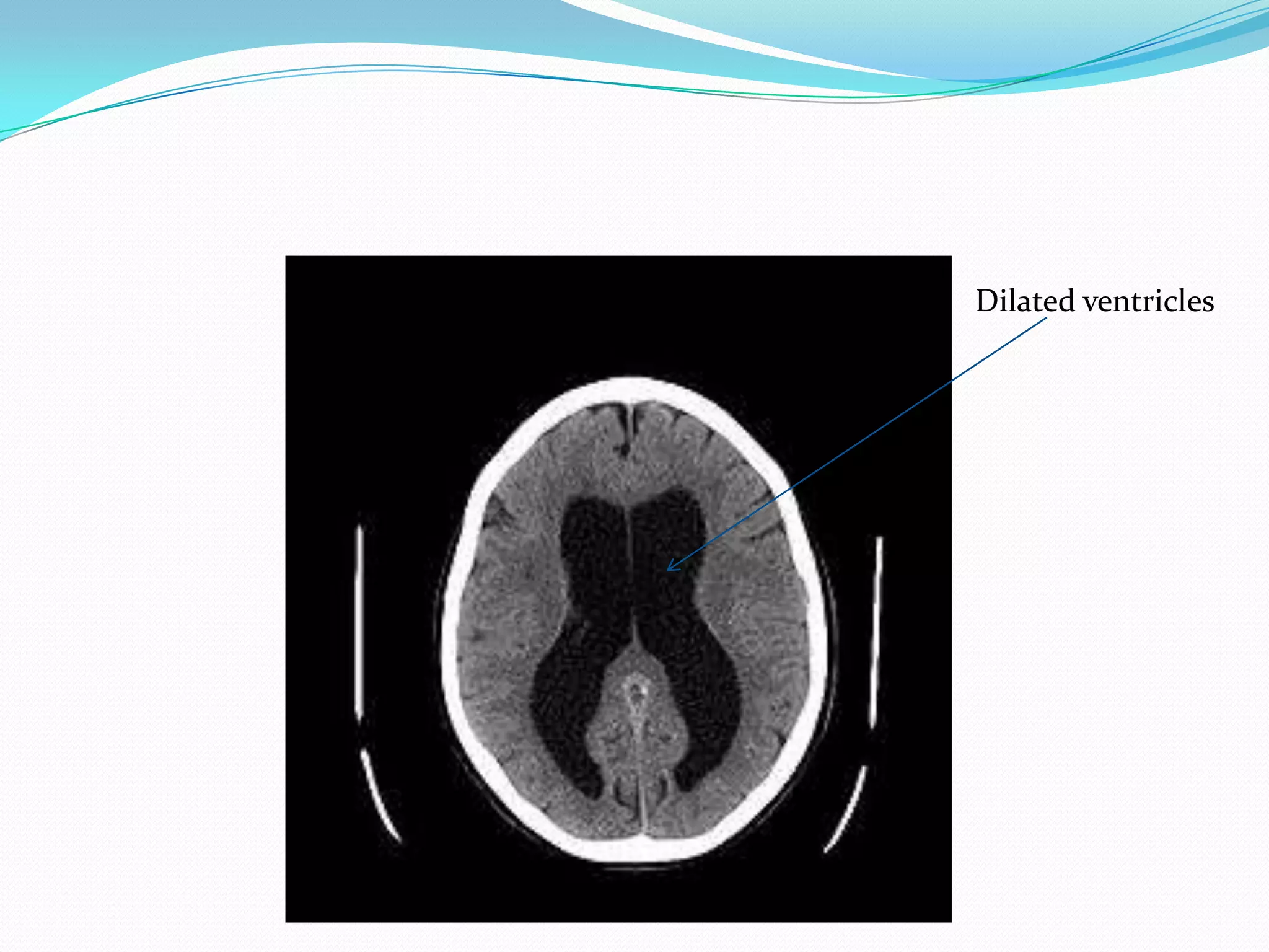 Hydrocephalus | PPTX