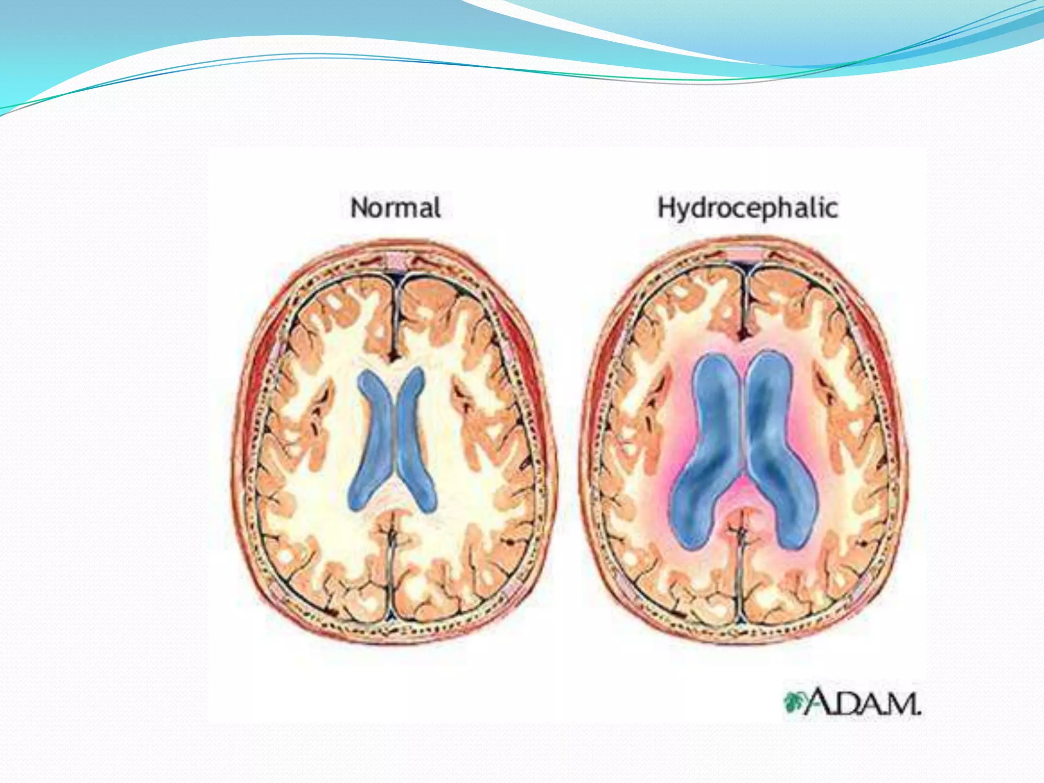 Hydrocephalus | PPTX