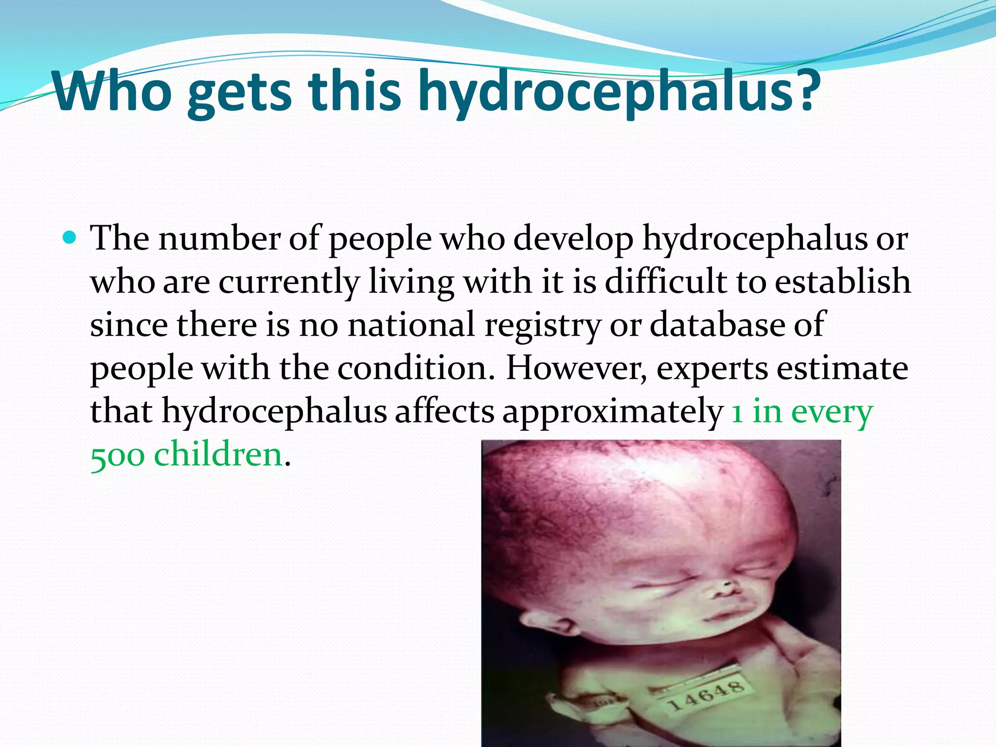 Hydrocephalus | PPTX