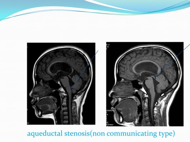 Hydrocephalus | PPTX | Brain and Nervous System Disorders | Diseases ...