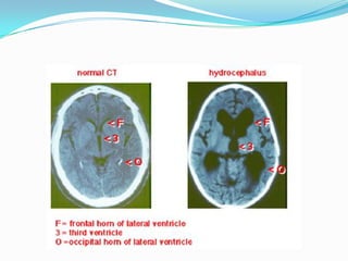 Hydrocephalus | PPTX