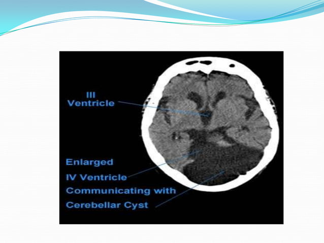 Hydrocephalus | PPTX | Brain and Nervous System Disorders | Diseases ...