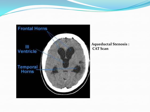 Hydrocephalus | PPTX | Brain and Nervous System Disorders | Diseases ...