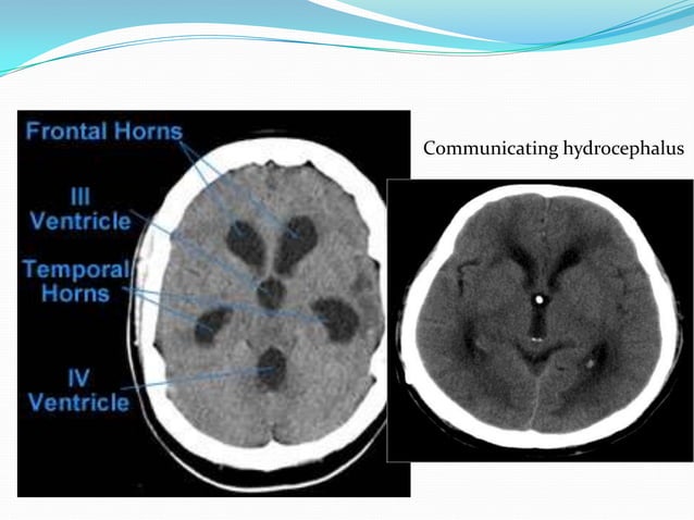 Hydrocephalus | PPTX | Brain and Nervous System Disorders | Diseases ...