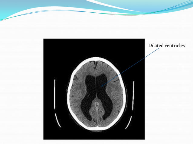 Hydrocephalus | PPTX | Brain and Nervous System Disorders | Diseases ...