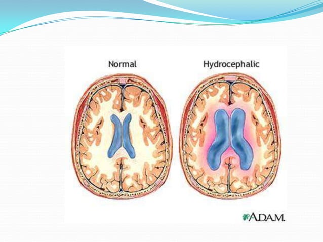 Hydrocephalus | PPTX | Brain and Nervous System Disorders | Diseases and Conditions