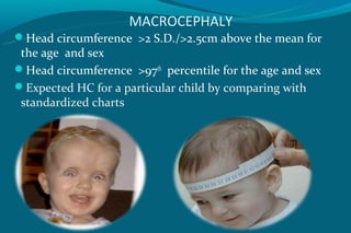 Hydrocephalus | PPT