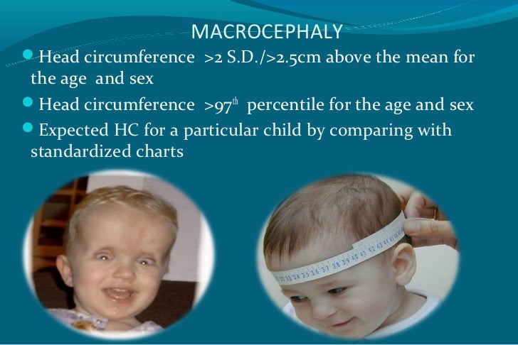 Hydrocephalus