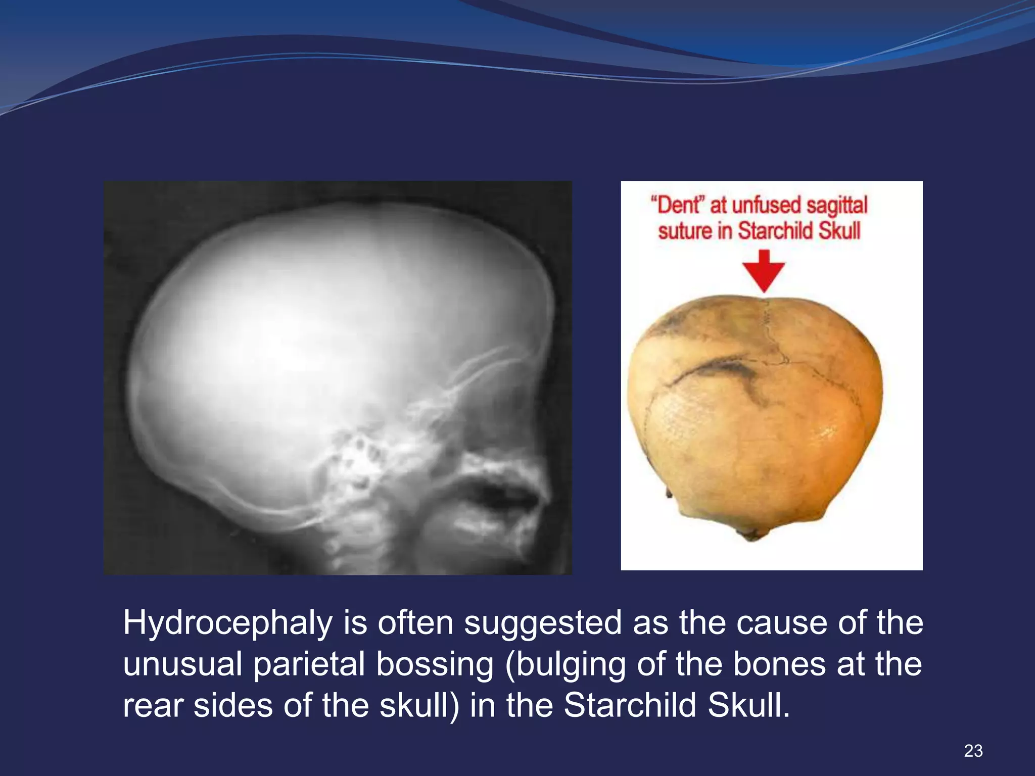 Hydrocephalus | PPTX