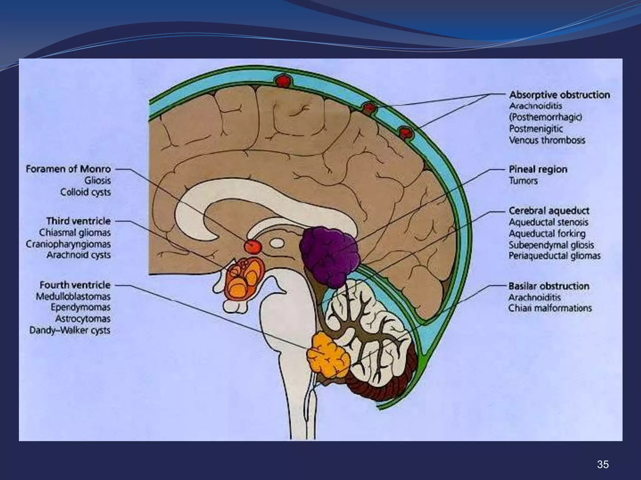 Hydrocephalus | PPTX