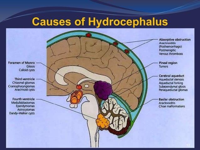 Hydrocephalus | PPTX