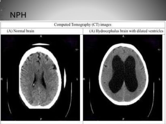 Hydrocephalus