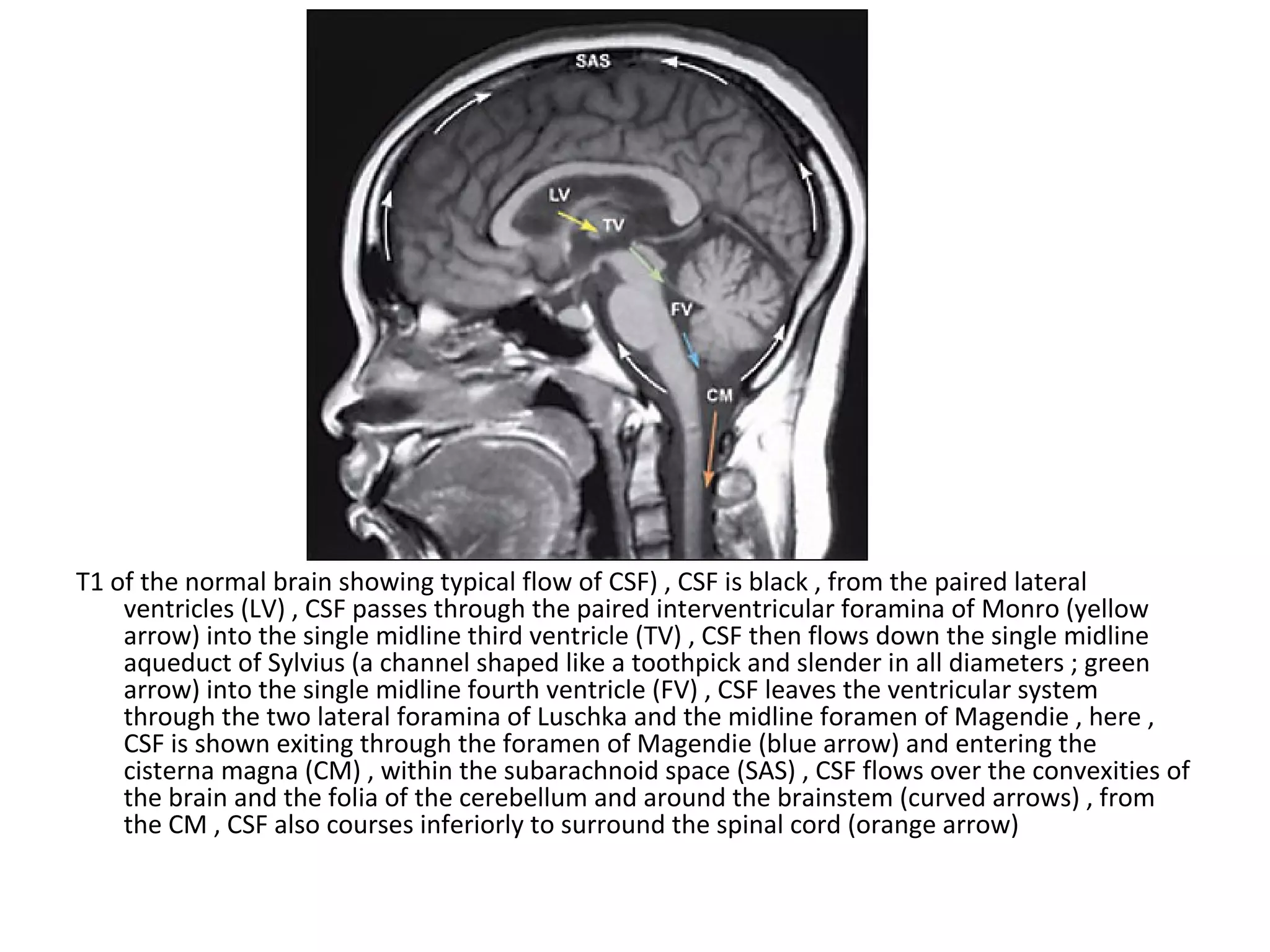 Diagnostic Imaging of Hydrocephalus & Pneumocephalus | PPT