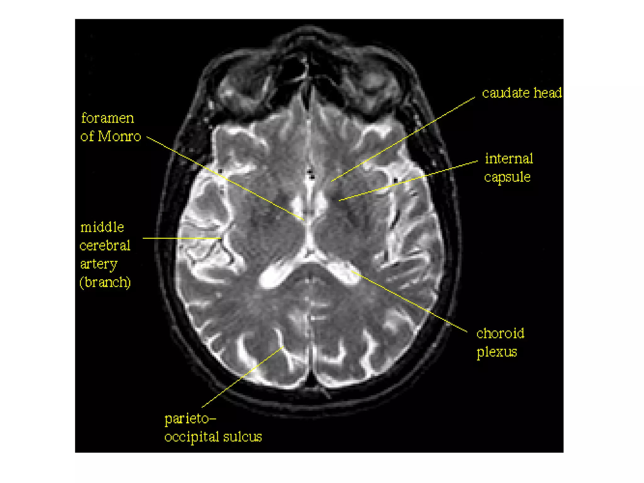 Diagnostic Imaging of Hydrocephalus & Pneumocephalus | PPT