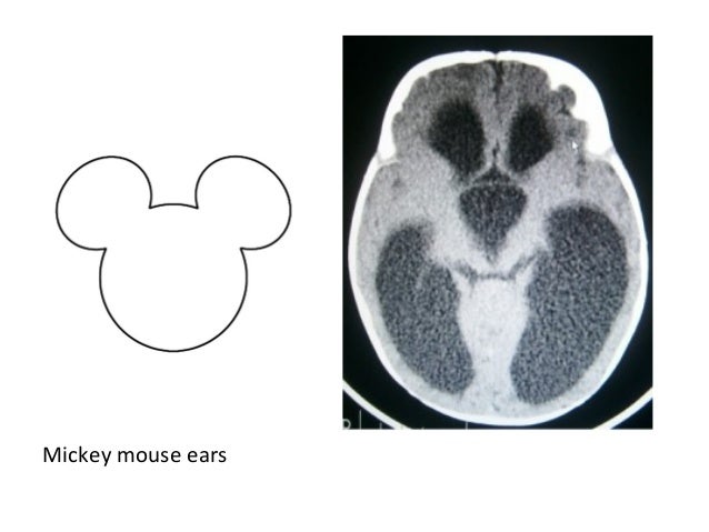 Diagnostic Imaging of Hydrocephalus & Pneumocephalus