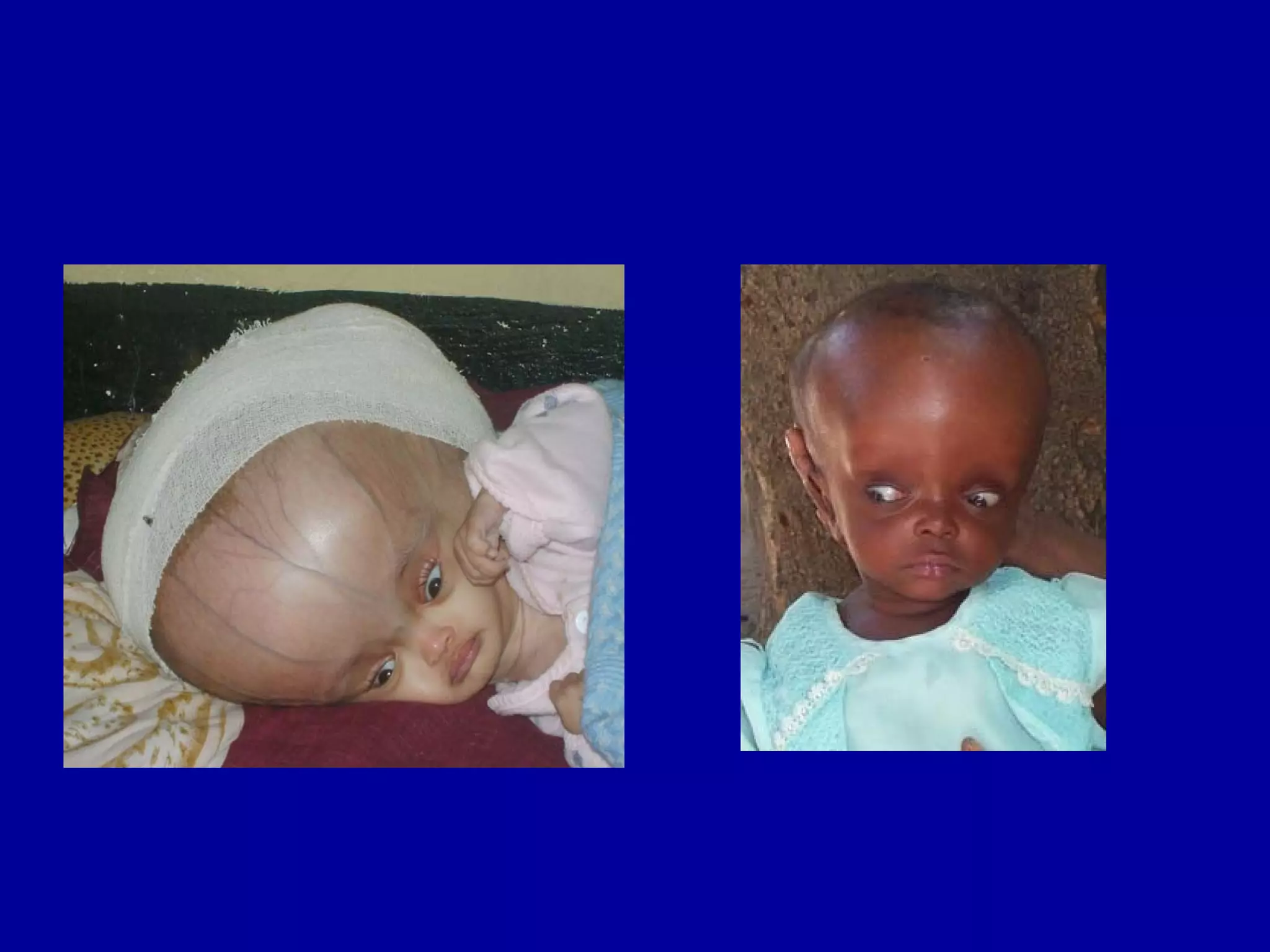 Hydrocephalus | PPT