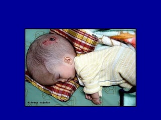 Hydrocephalus | PPT