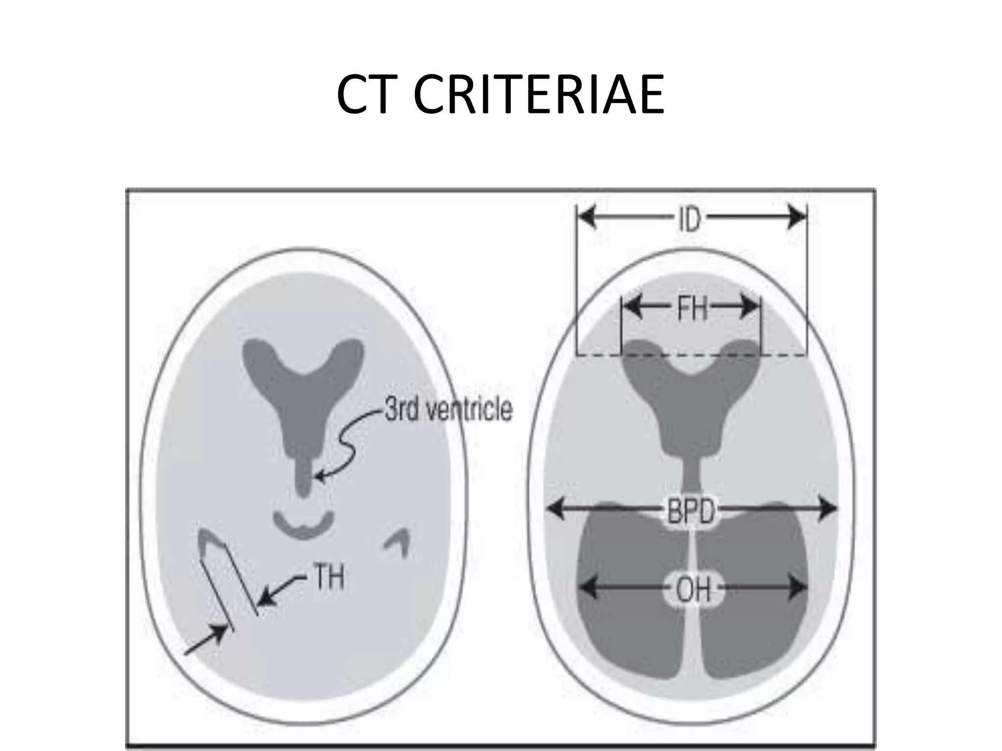 Hydrocephalus diagnosis and management | PPTX