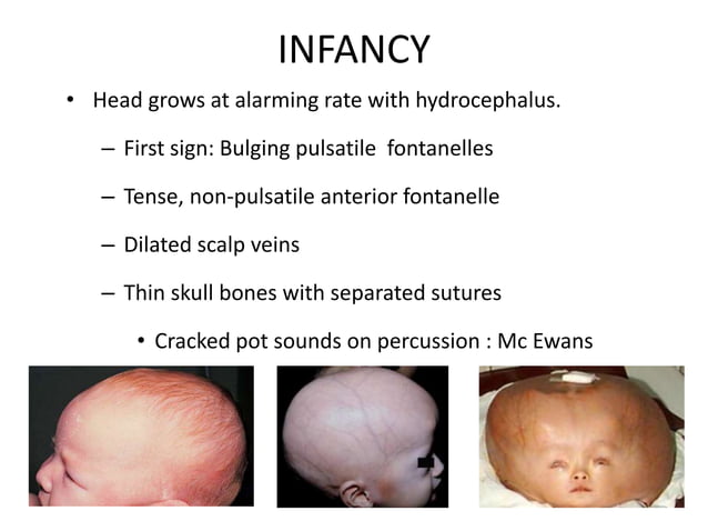 Hydrocephalus diagnosis and management | PPTX | Brain and Nervous ...