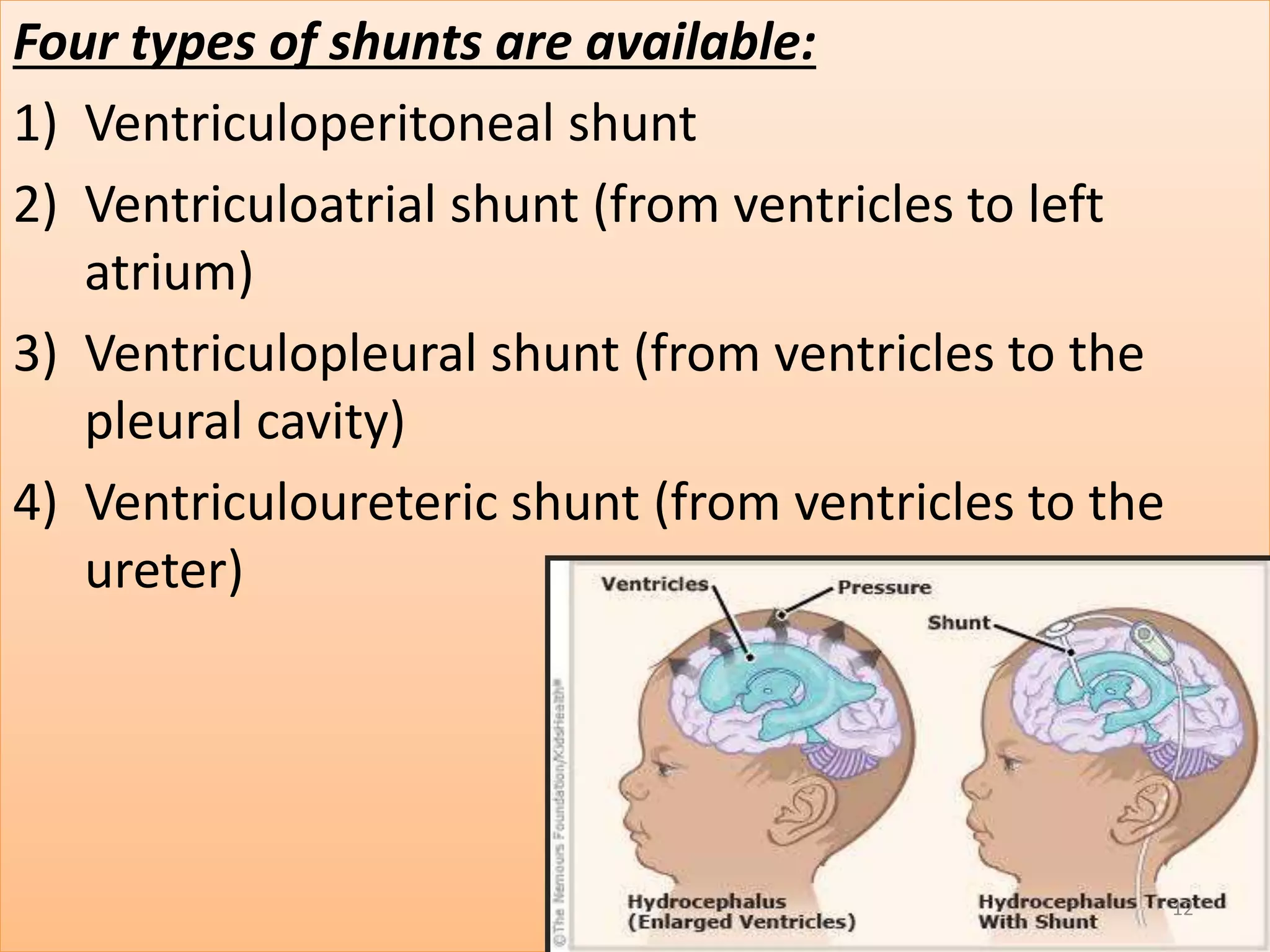 Hydrocephalus disease | PPTX