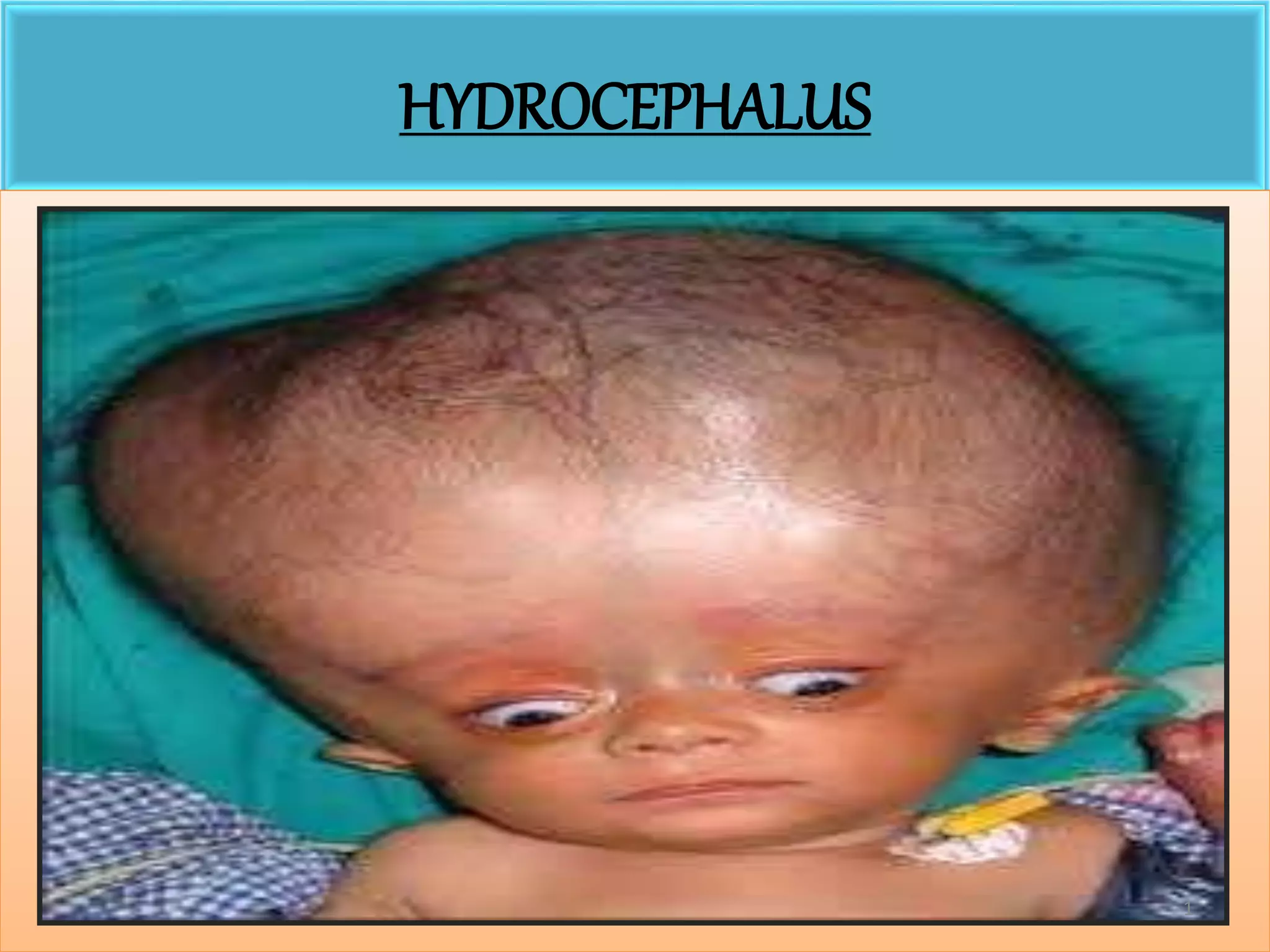 Understanding Hydrocephalus in Infants | PPT