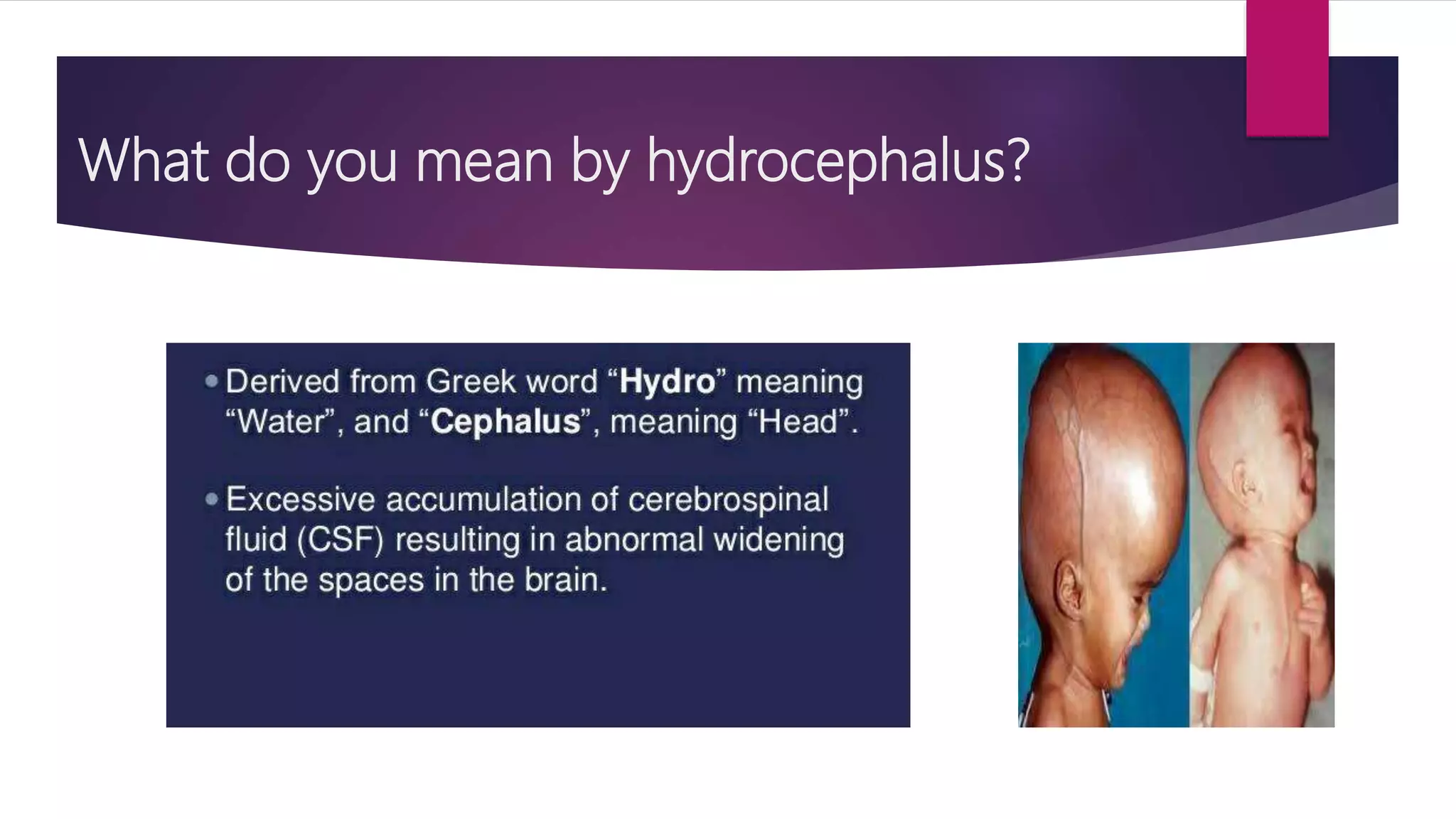 Hydrocephalus | PPT