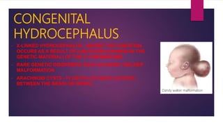 Hydrocephalus | PPTX