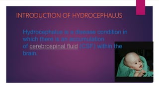 Hydrocephalus | PPTX