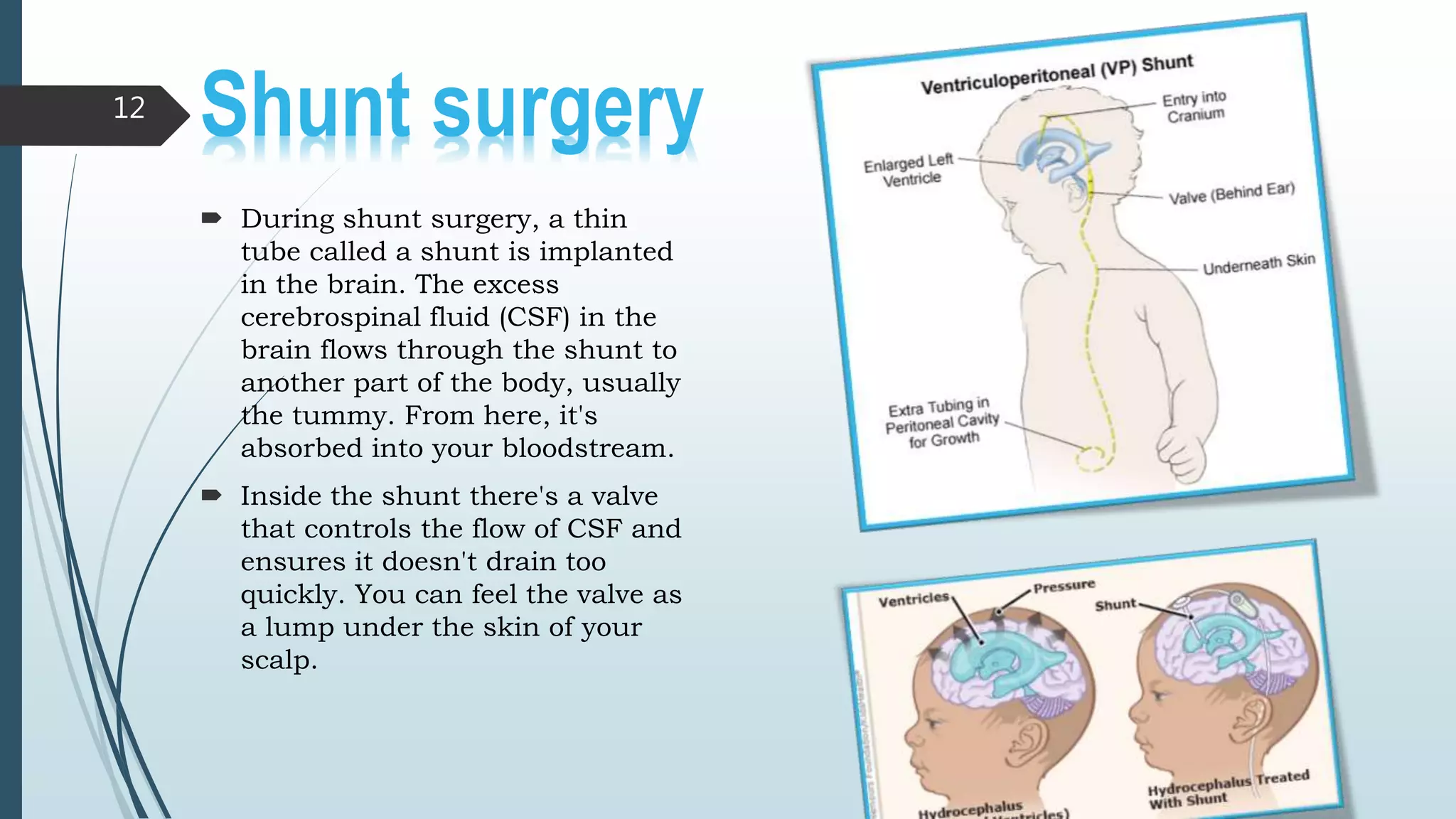 Hydrocephalus by aram mustafa & Narnj wasman & Daroon Abdulrahman | PPT