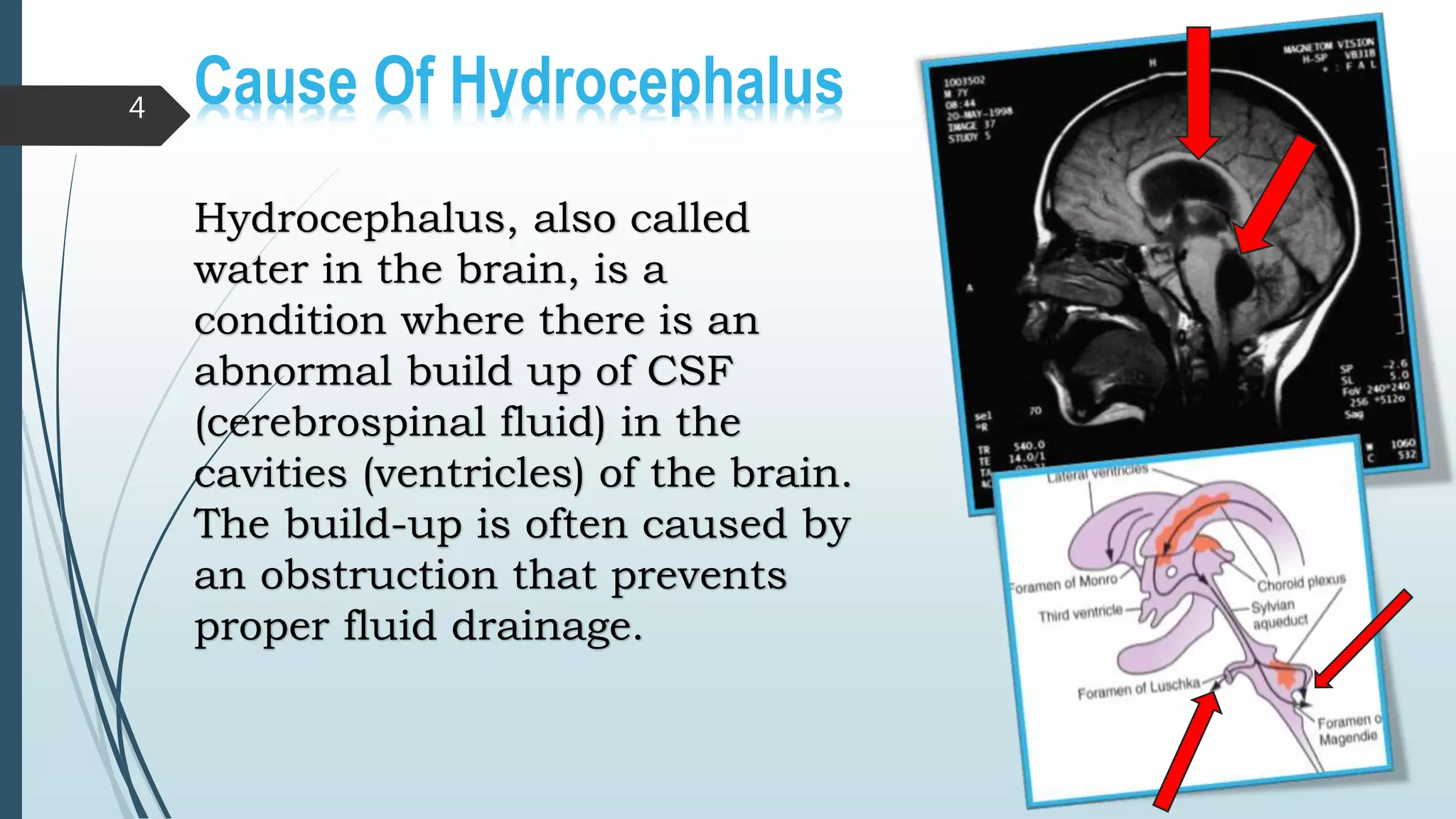 Hydrocephalus by aram mustafa & Narnj wasman & Daroon Abdulrahman | PPT