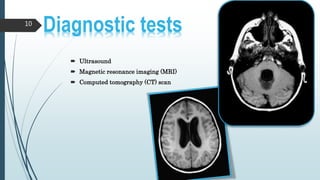 Hydrocephalus by aram mustafa & Narnj wasman & Daroon Abdulrahman | PPT