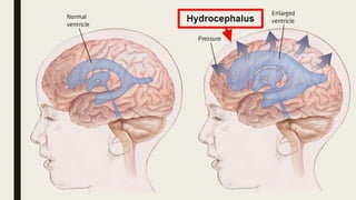 Hydrocephalus (Clinical Anatomy of CSF) By Muhammad Arslan Yasin | PPTX
