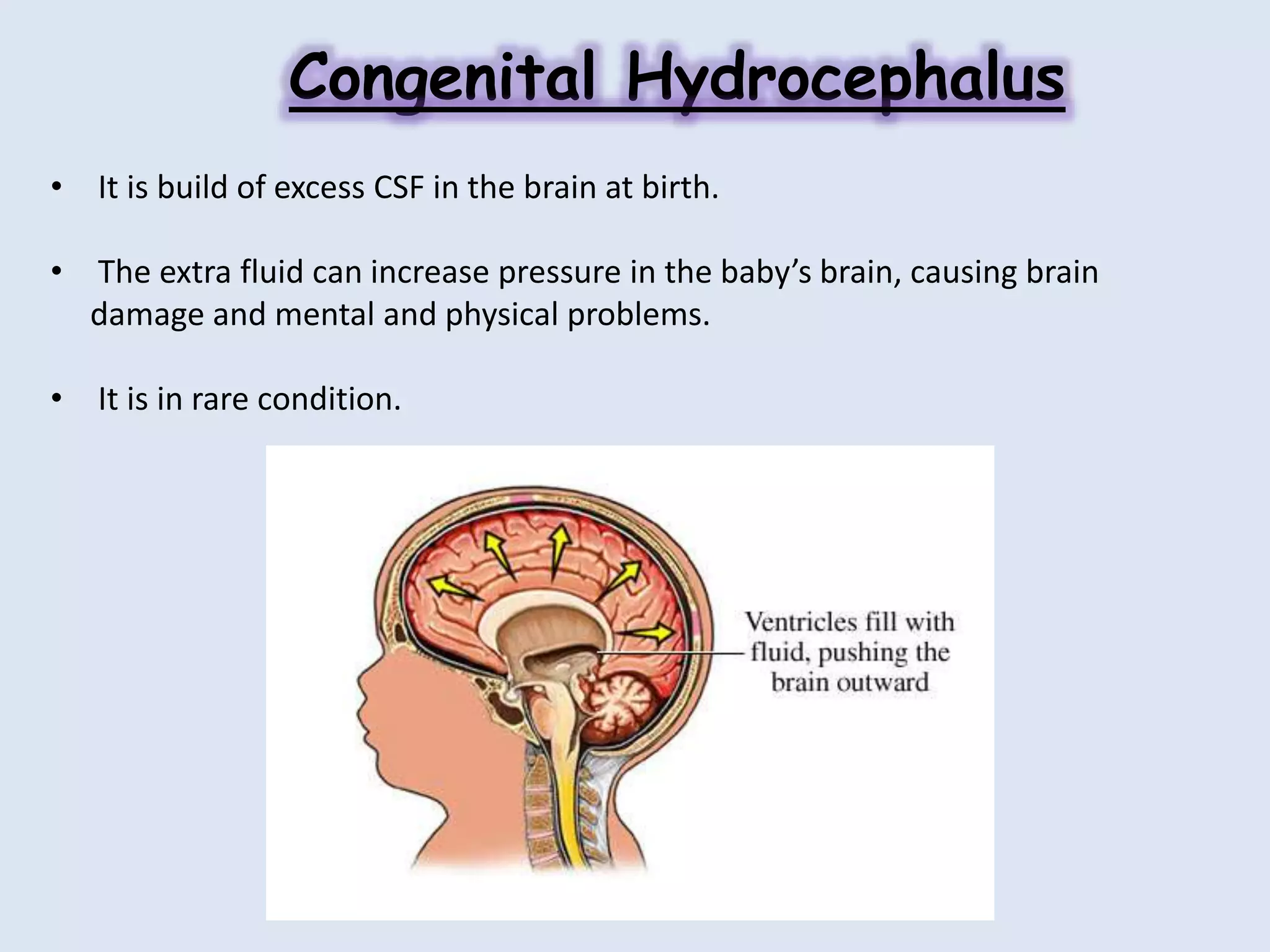 Hydrocephalus | PPTX