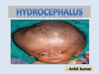 Hydrocephalus | PPTX