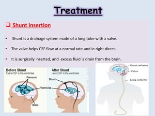 Hydrocephalus | PPTX